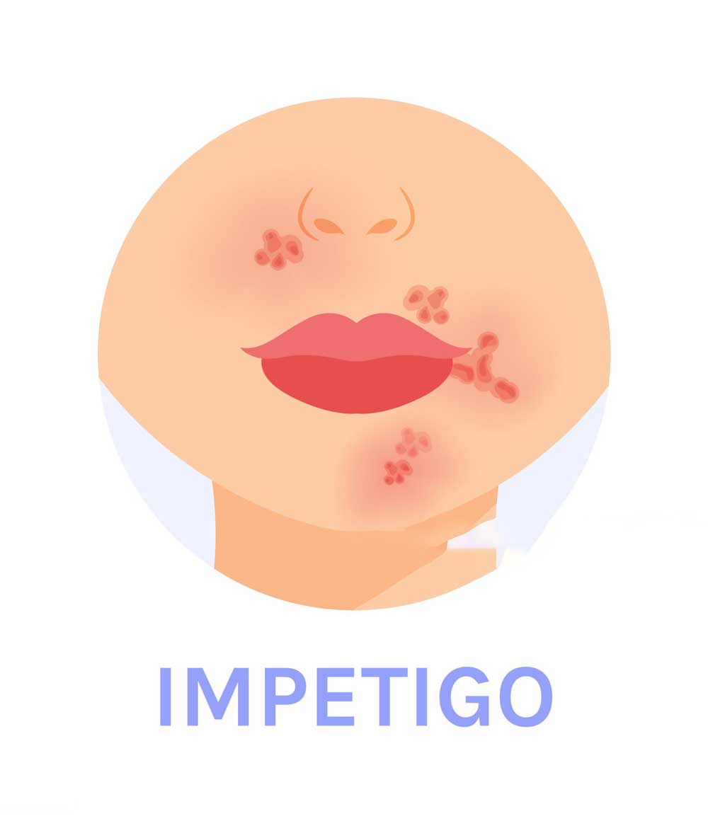 Impetigo Treatment In Nashik | Shine Skin Hair And Laser Clinic